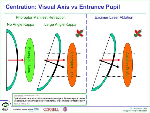 Centration of Hyperopic Corneal Ablations: Corneal Vertex vs. Pupil ...