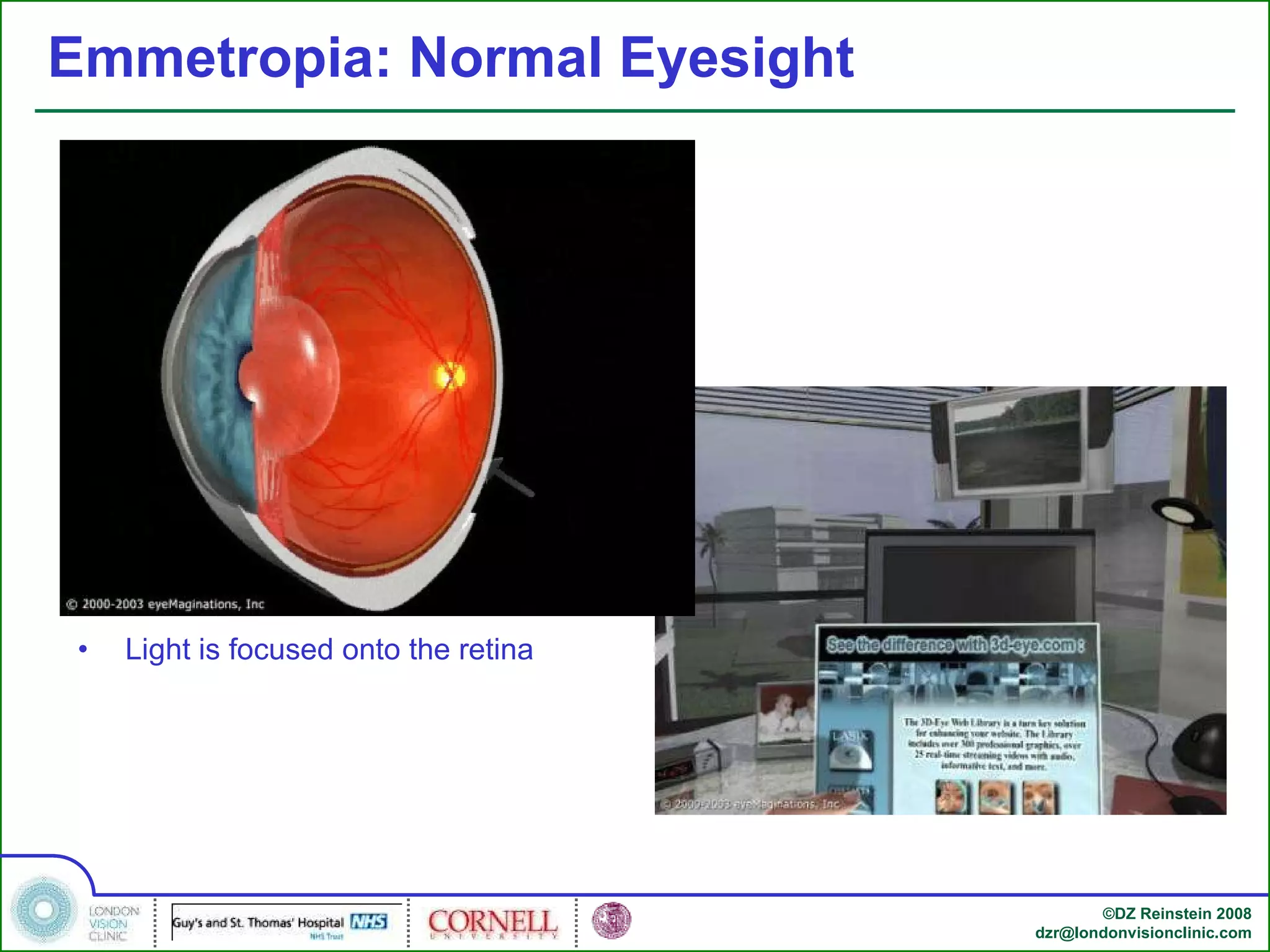 Introduction to Refractive Eye Surgery | PPT