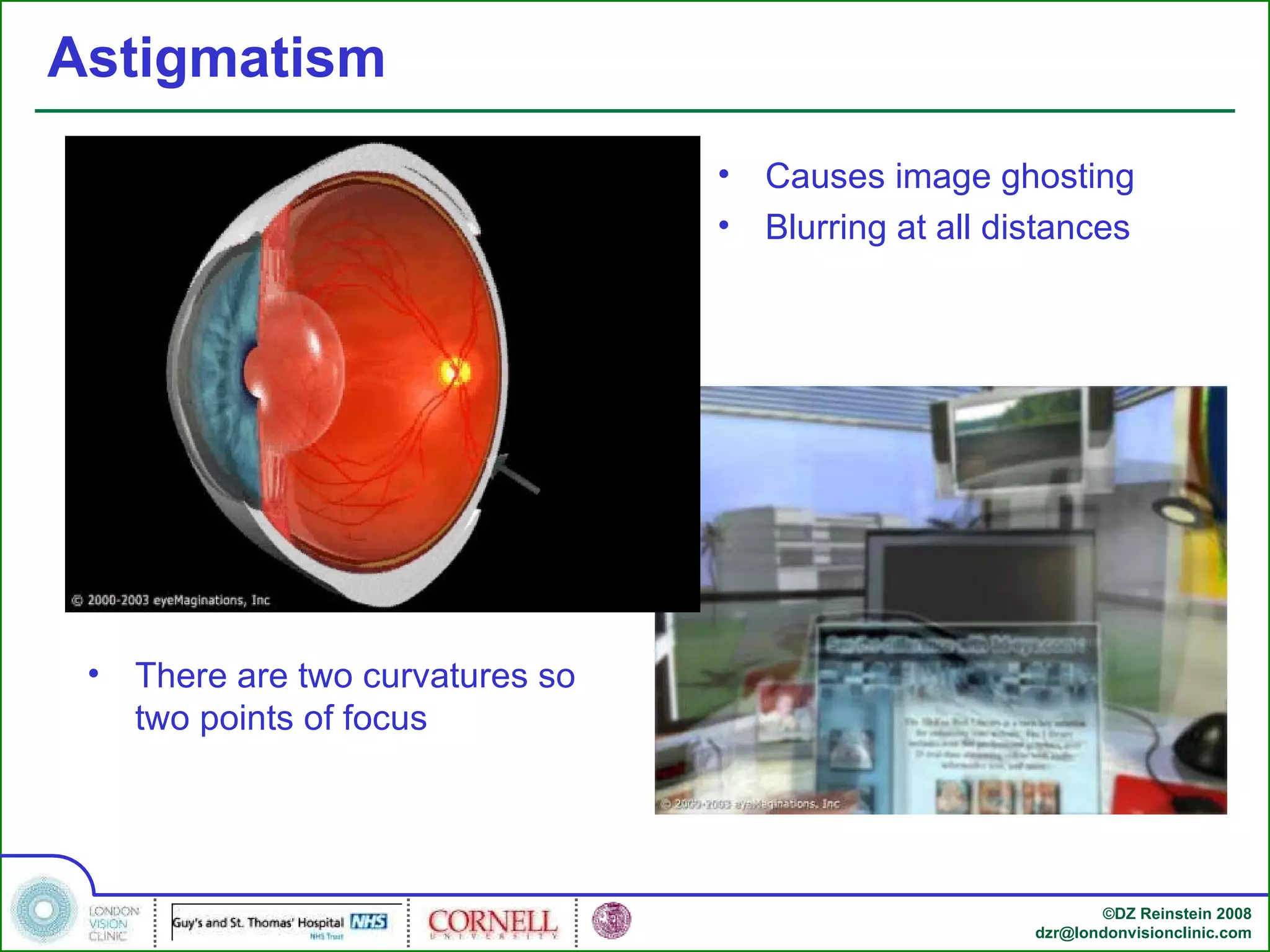 Introduction to Refractive Eye Surgery | PPT