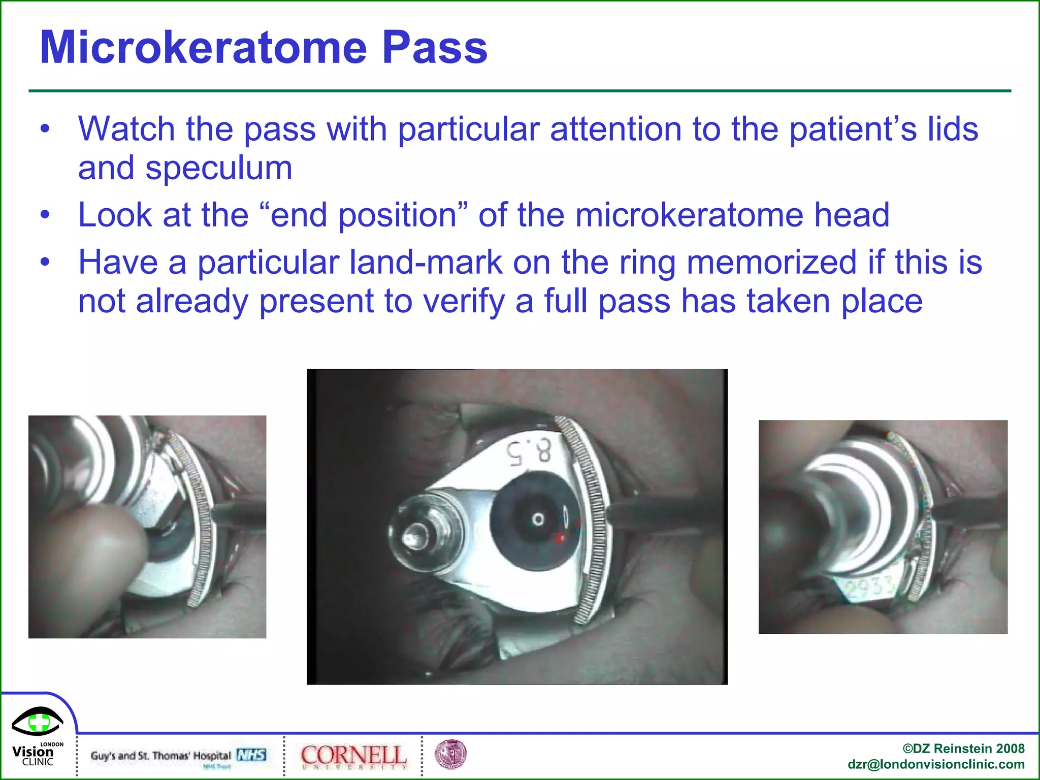 The Routine LASIK Procedure | PPT