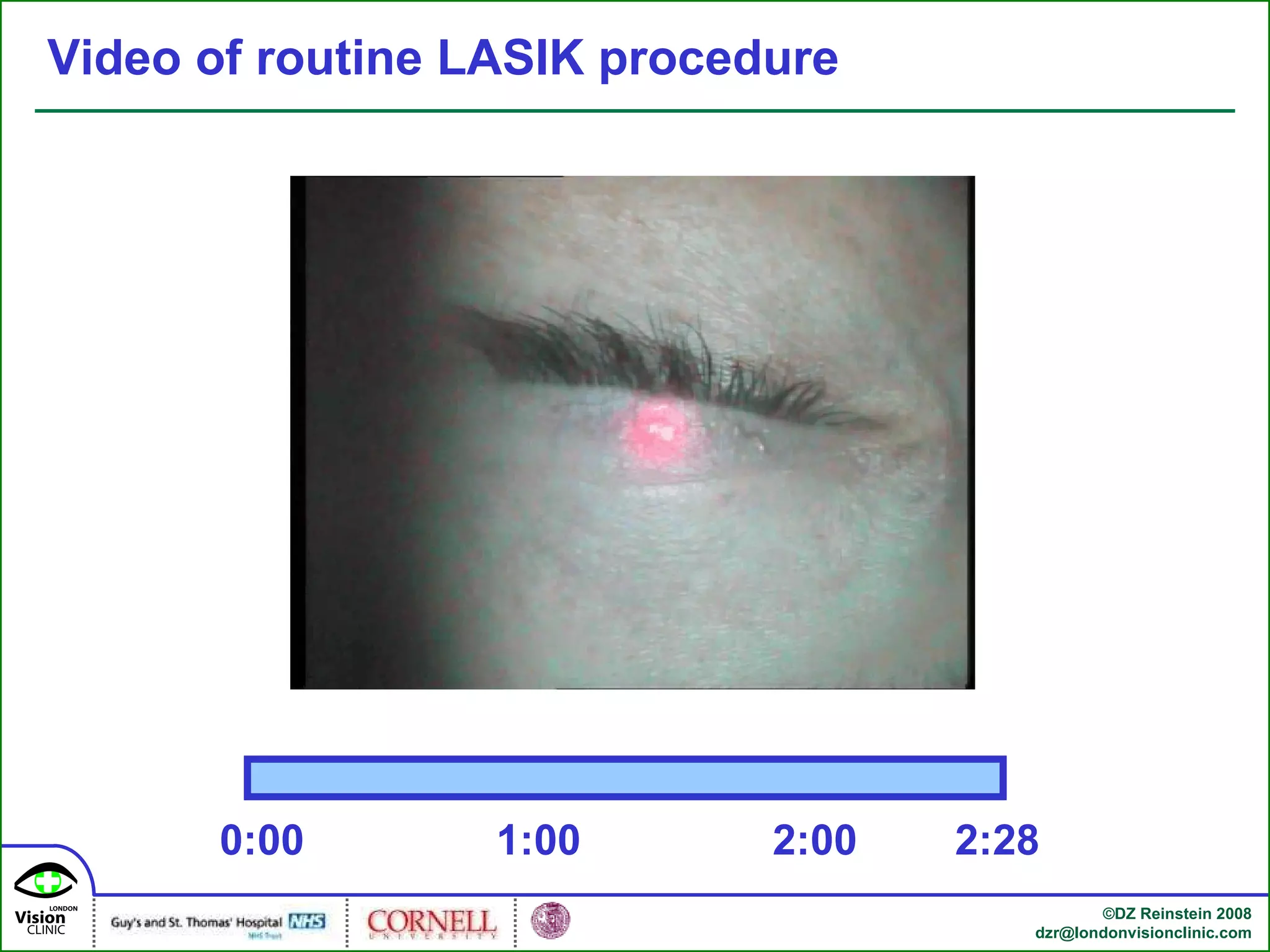 The Routine LASIK Procedure | PPT