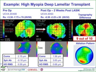 6 Month Results of Topography Guided Repair | PPT | Eye and Vision ...