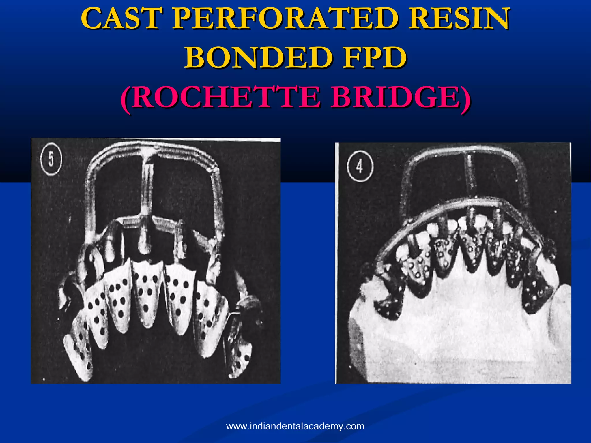 Resin bonded prosthesis /certified fixed orthodontic courses by Indian ...