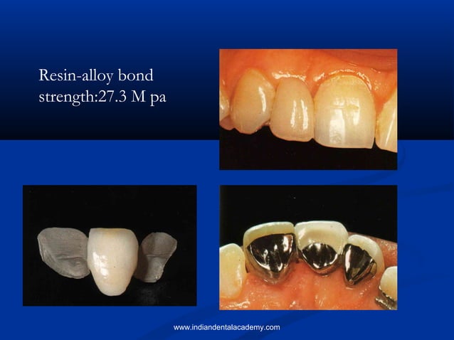 Resin bonded prosthesis /certified fixed orthodontic courses by Indian ...