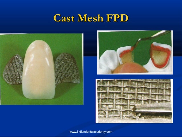 Resin bonded prosthesis /certified fixed orthodontic courses by India…