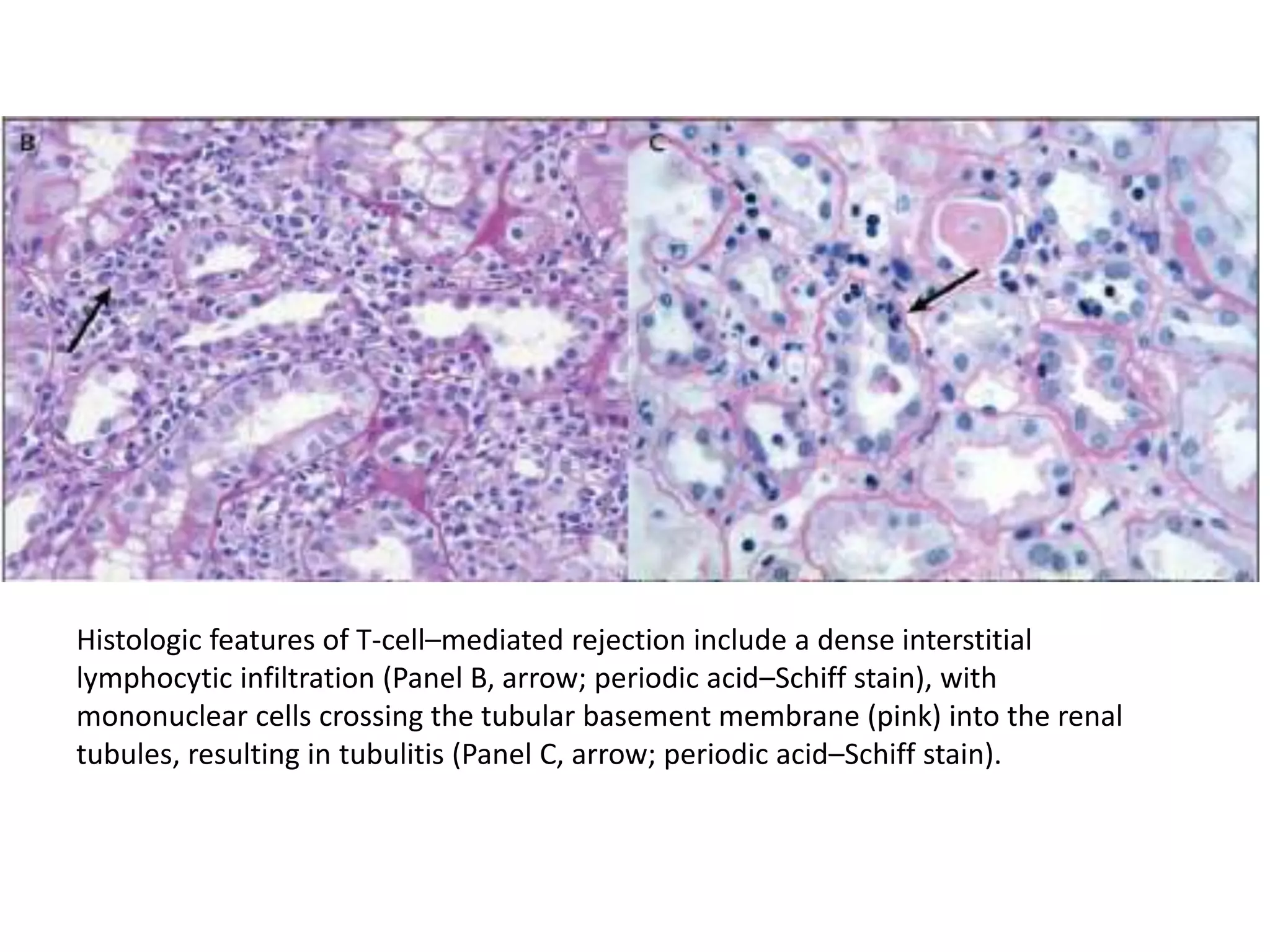 Rejection of the kidney allograft | PPTX