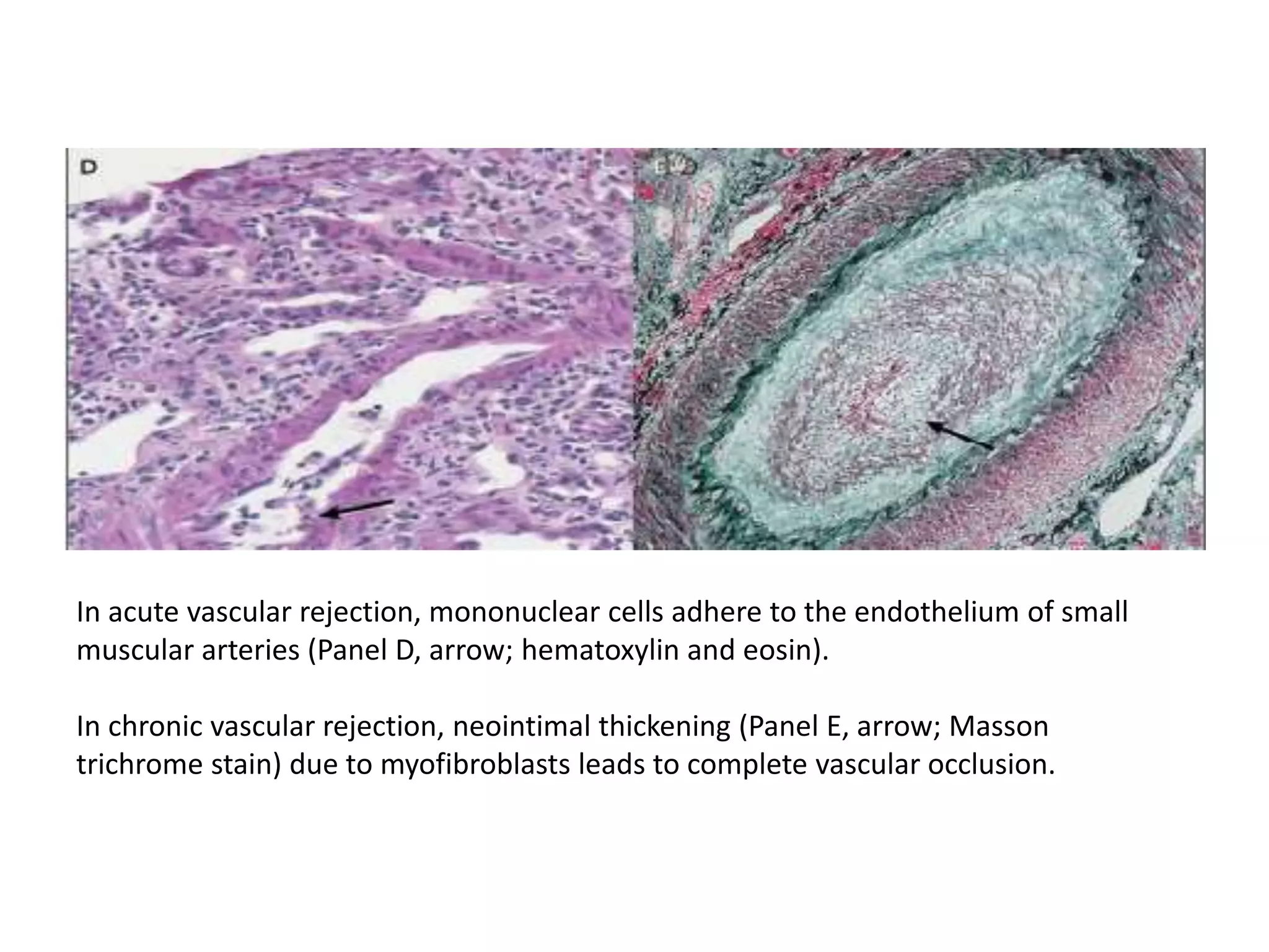 Rejection of the kidney allograft | PPTX
