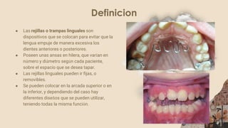 rejilla lingual.pptx