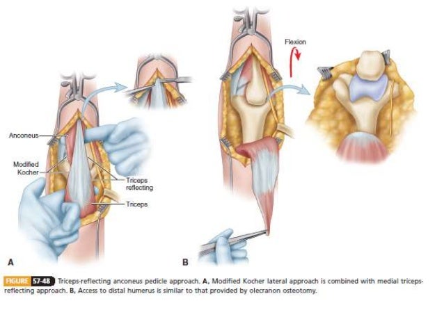 Distal Humerus Fracture Management- Rejul