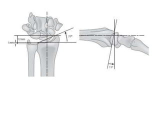 Distal Radius Fractures- Journal club | PPTX