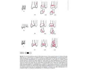 Distal Radius Fractures- Journal club | PPTX