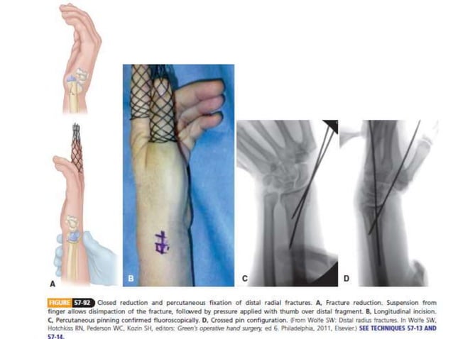 Distal Radius Fractures- Journal club | PPT