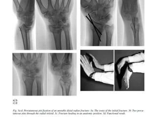 Distal Radius Fractures- Journal club | PPTX