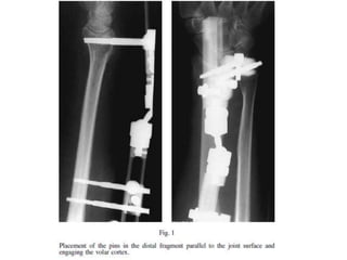 Distal Radius Fractures- Journal club | PPTX