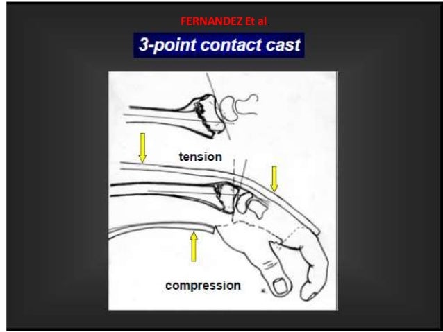 Distal Radius Fractures- Journal club