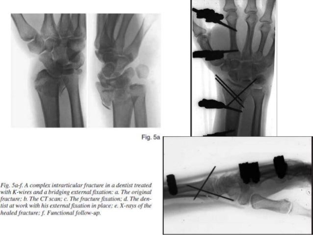 Distal Radius Fracture Kapandji Intrafocal Pinning Technique