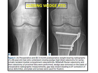 HTO vs UKA in unicompartmental OA Knee | PPTX