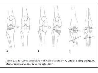 HTO vs UKA in unicompartmental OA Knee | PPTX