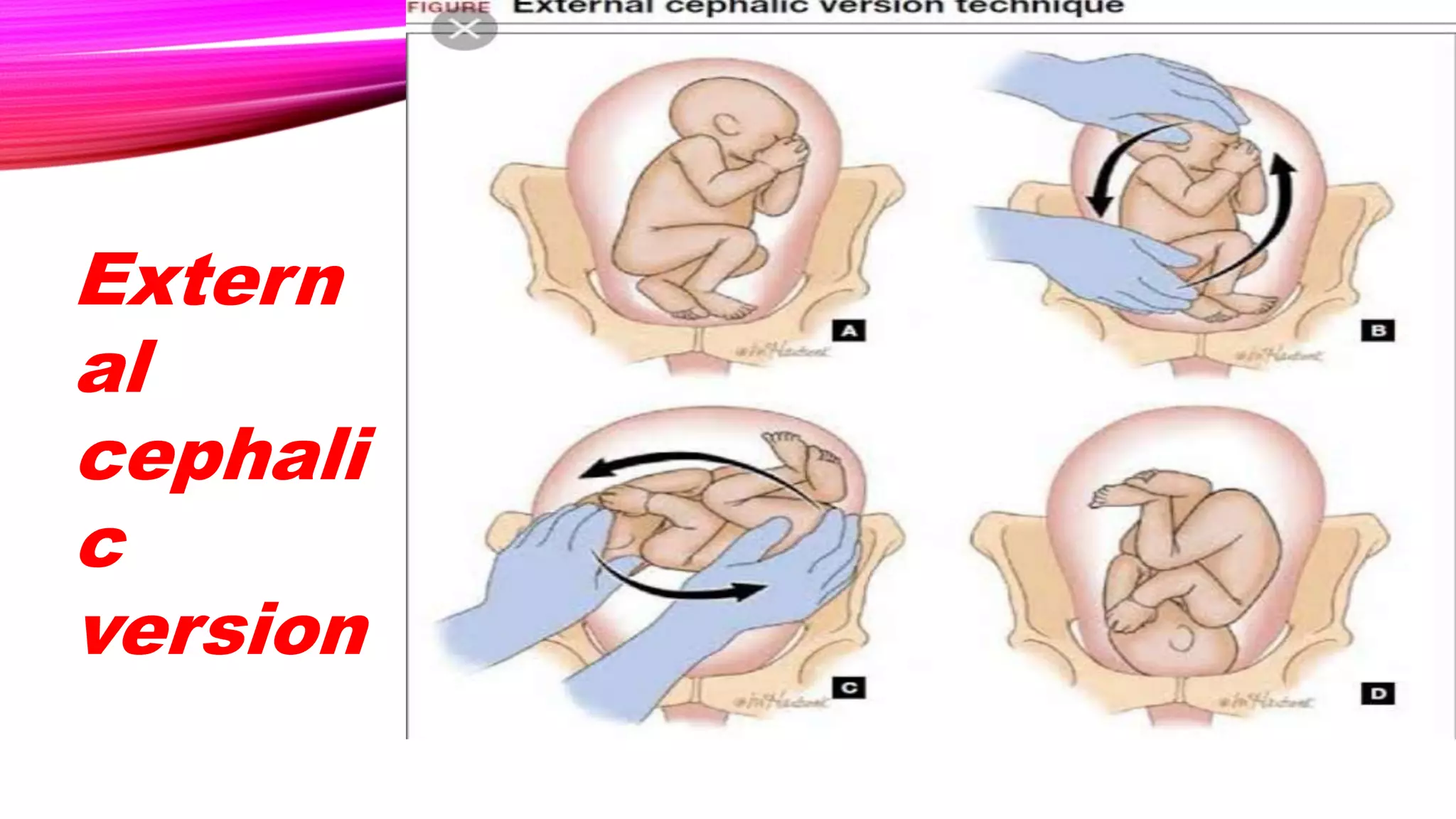 breech presentation | PPTX