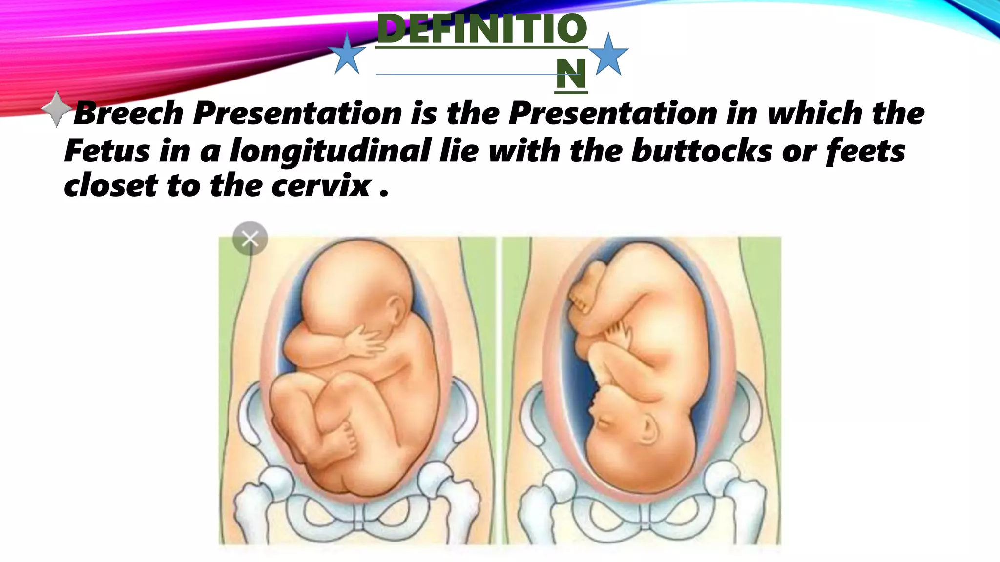 breech presentation | PPTX