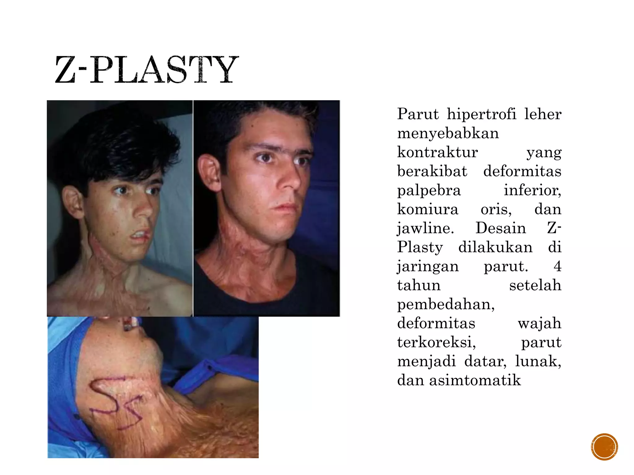 Rekonstruksi Luka Bakar Fase Lanjut | PPTX