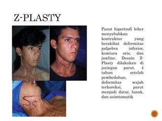 Rekonstruksi Luka Bakar Fase Lanjut | PPTX