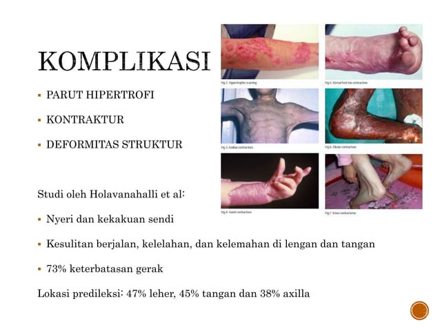 Rekonstruksi Luka Bakar Fase Lanjut | PPTX