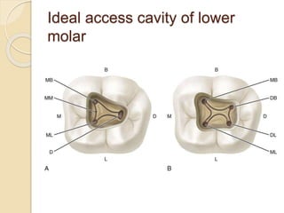 Relation ofaccess cavity design to the canal orifice | PPTX