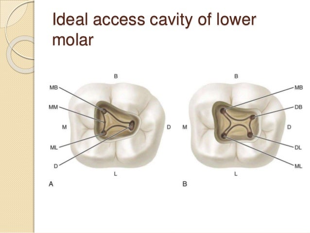 Relation ofaccess cavity design to the canal orifice