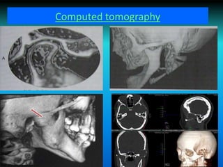 Relationship of tmj anatomy and pathology and related | PPTX