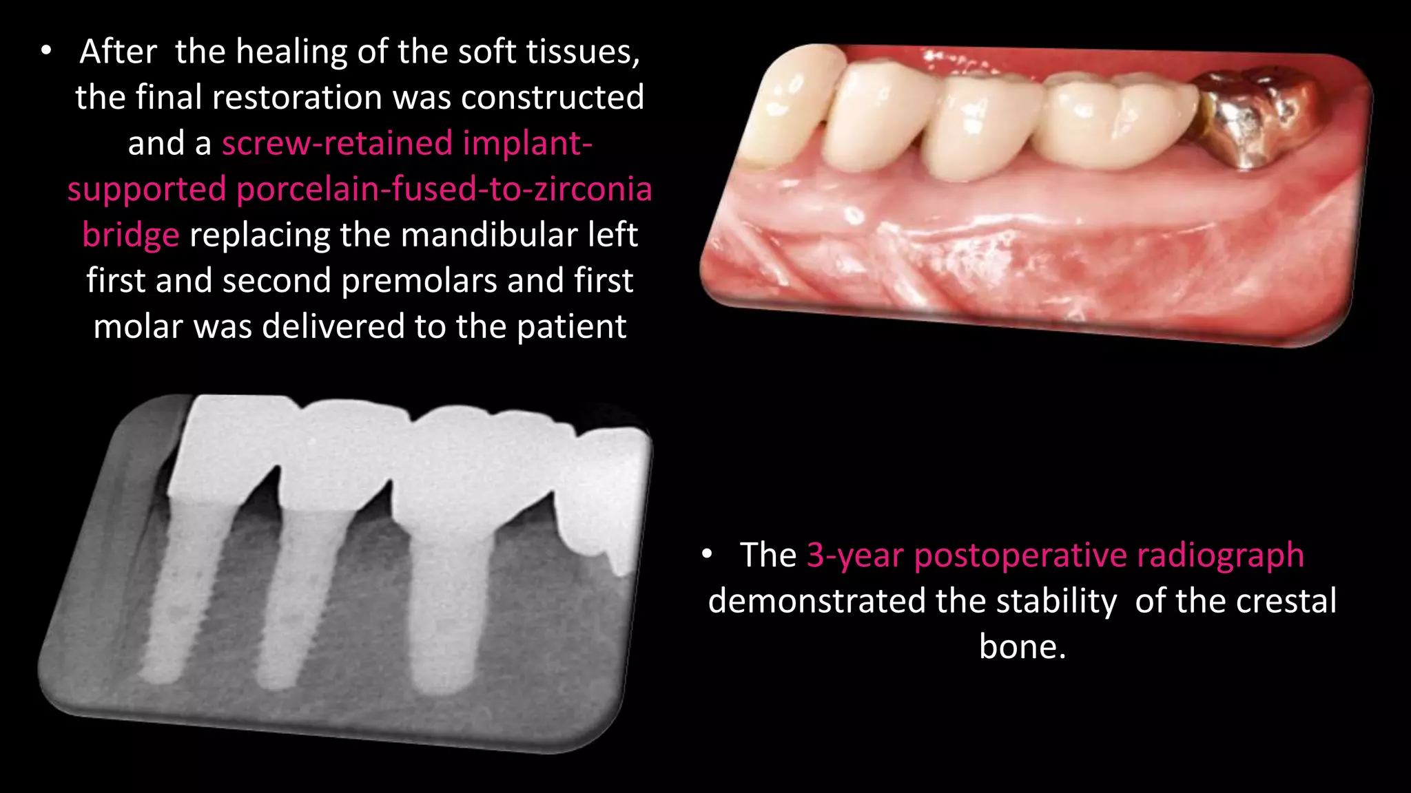 Releasing Incisions Using Upward-Motion Scissors Technique for Flap ...
