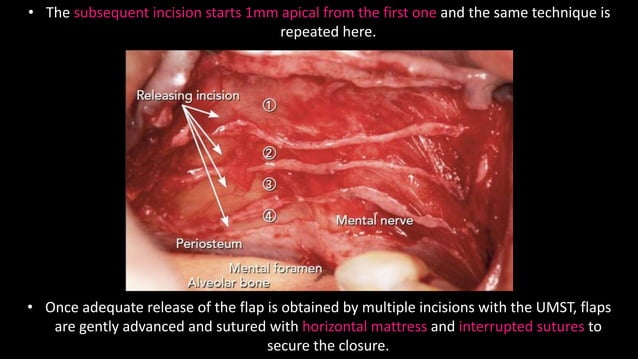 Releasing Incisions Using Upward-Motion Scissors Technique for Flap ...