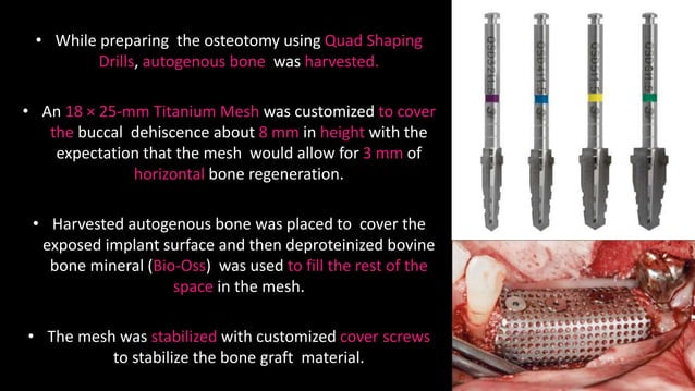 Releasing Incisions Using Upward-Motion Scissors Technique for Flap ...