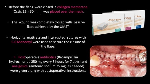 Releasing Incisions Using Upward-Motion Scissors Technique for Flap ...