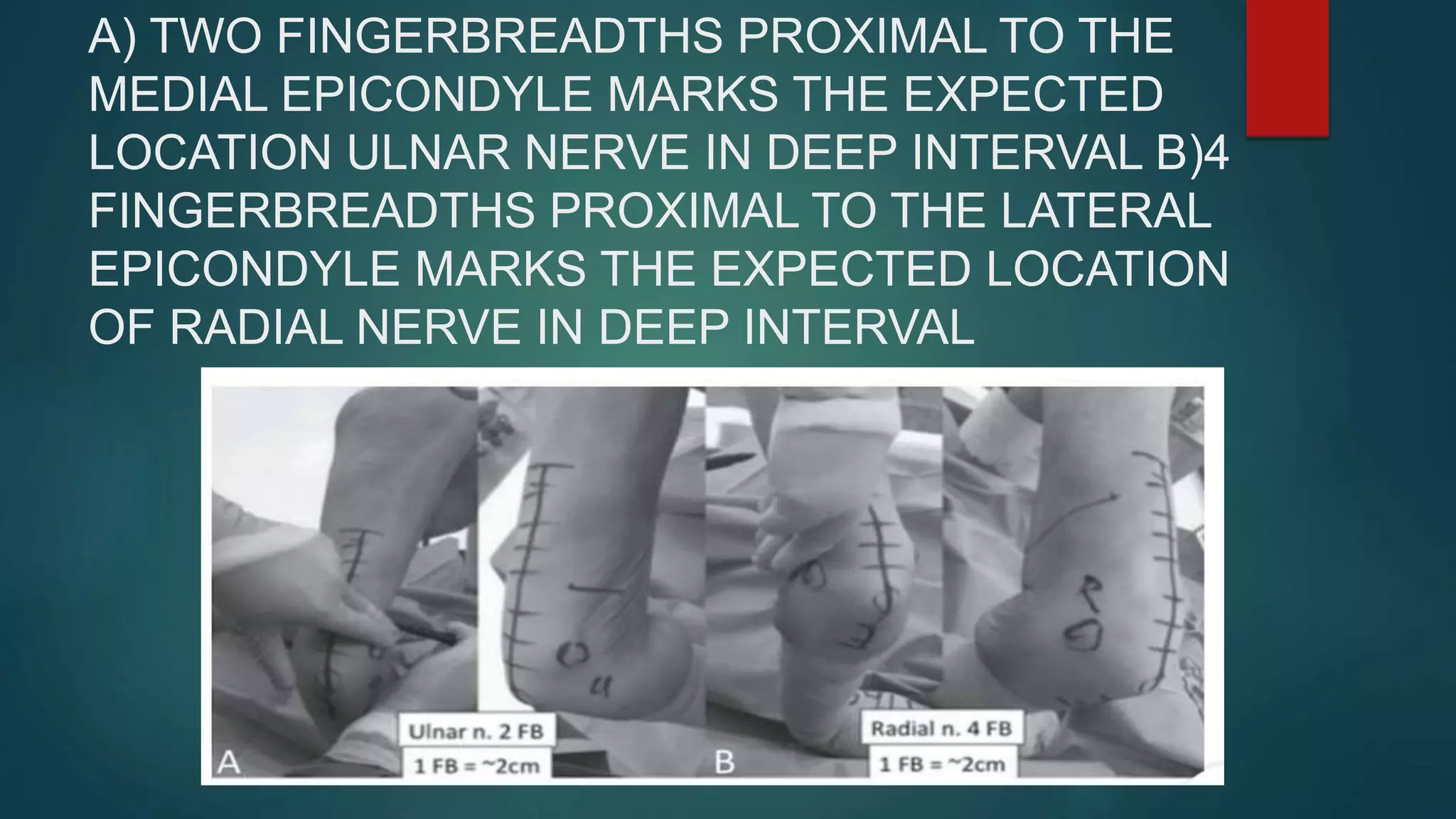 Reliable method of radial and ulnar nerve identification during the ...
