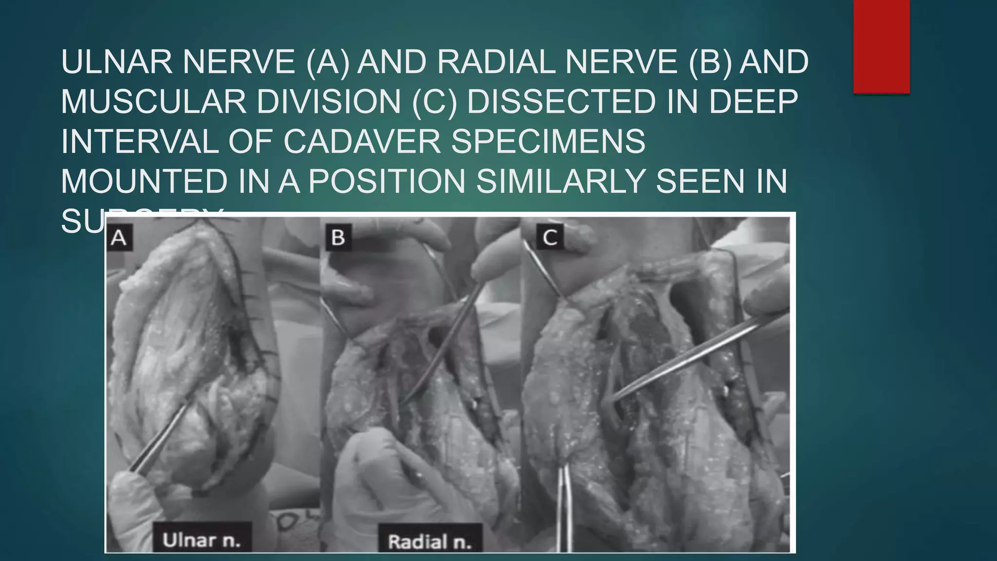 Reliable method of radial and ulnar nerve identification during the ...