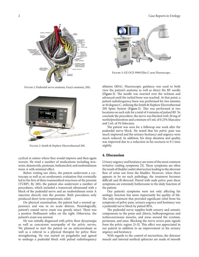 Relief of urinary urgency, hesitancy, and male pelvic pain with pulsed radiofrequency ablation ...