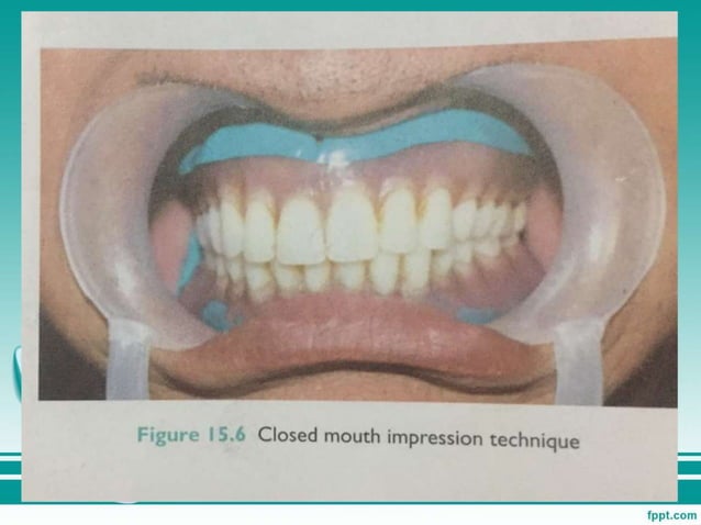 Relining and rebasing | PPTX | Dental Health | Diseases and Conditions