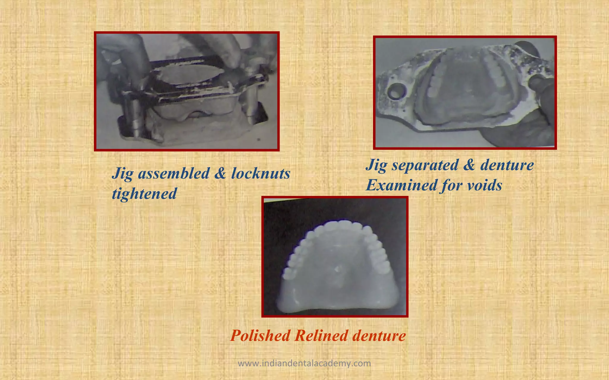 Relining and rebasing in complete dentures / Labial orthodontics ...