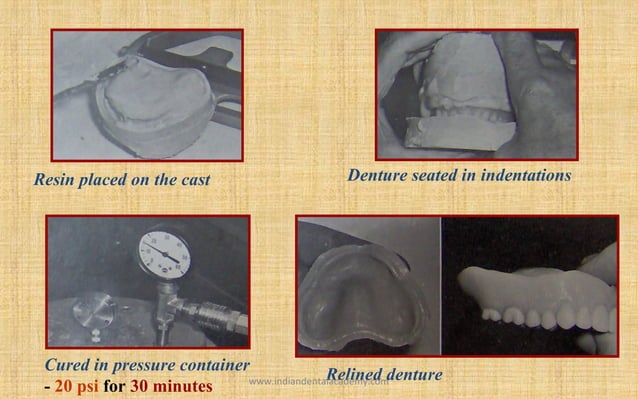 Relining and rebasing in complete dentures / Labial orthodontics ...