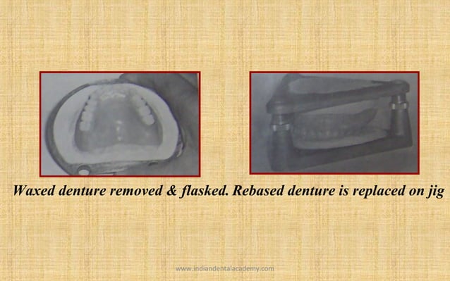 Relining and rebasing in complete dentures / Labial orthodontics ...