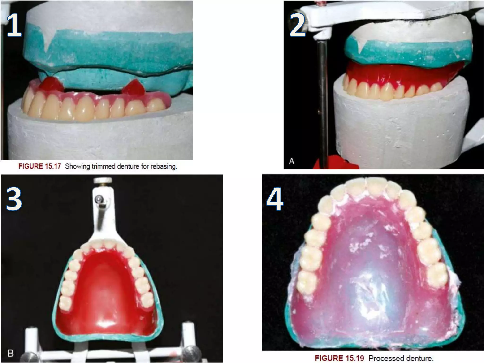 Relining and rebasing in complete dentures | PPTX
