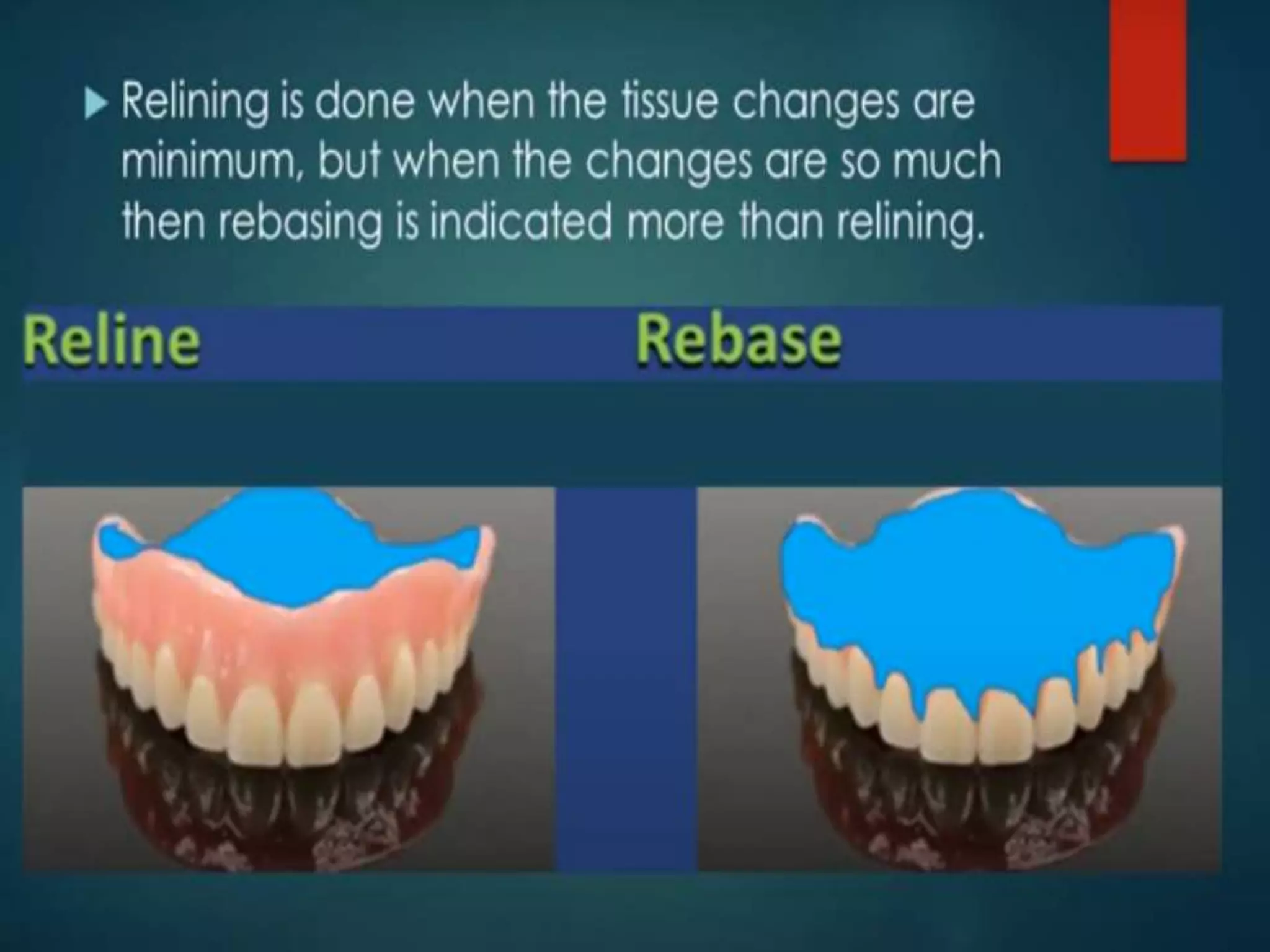 Relining and rebasing in complete dentures | PPTX