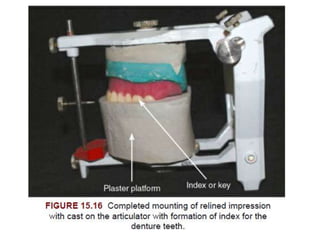 Relining and rebasing in complete dentures | PPTX
