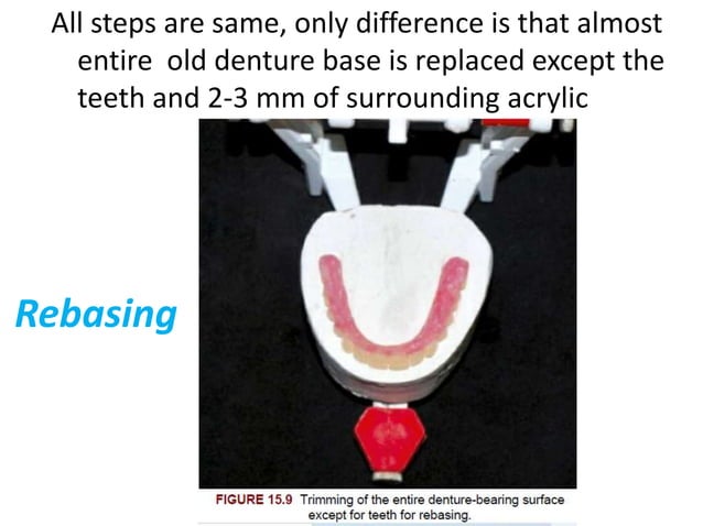 Relining and rebasing in complete dentures | PPTX | Dental Health ...