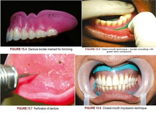 Relining and rebasing in complete dentures | PPTX