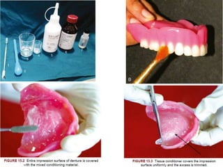Relining and rebasing in complete dentures | PPTX