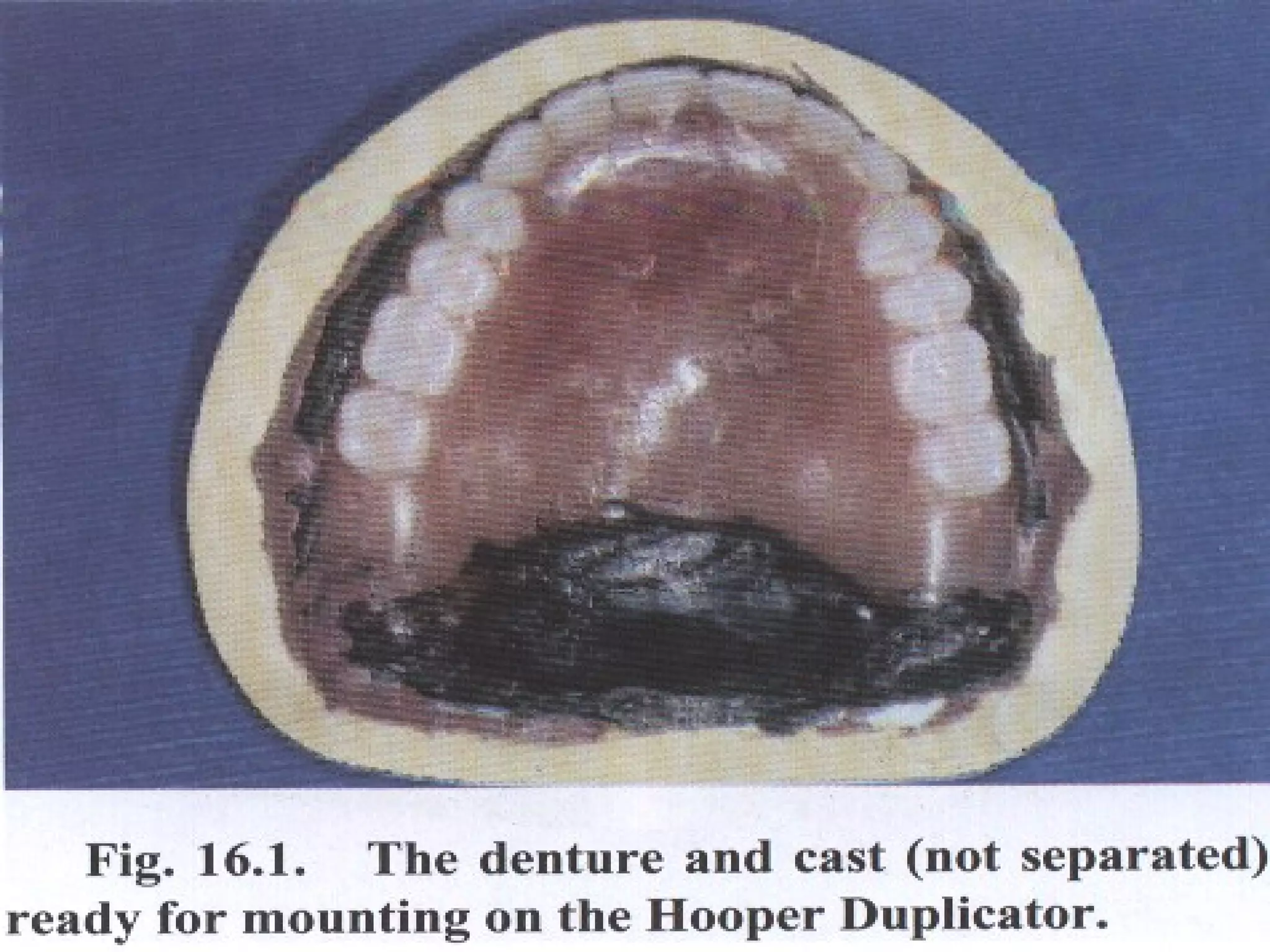 Relining and rebasing of complete dentures | PPT