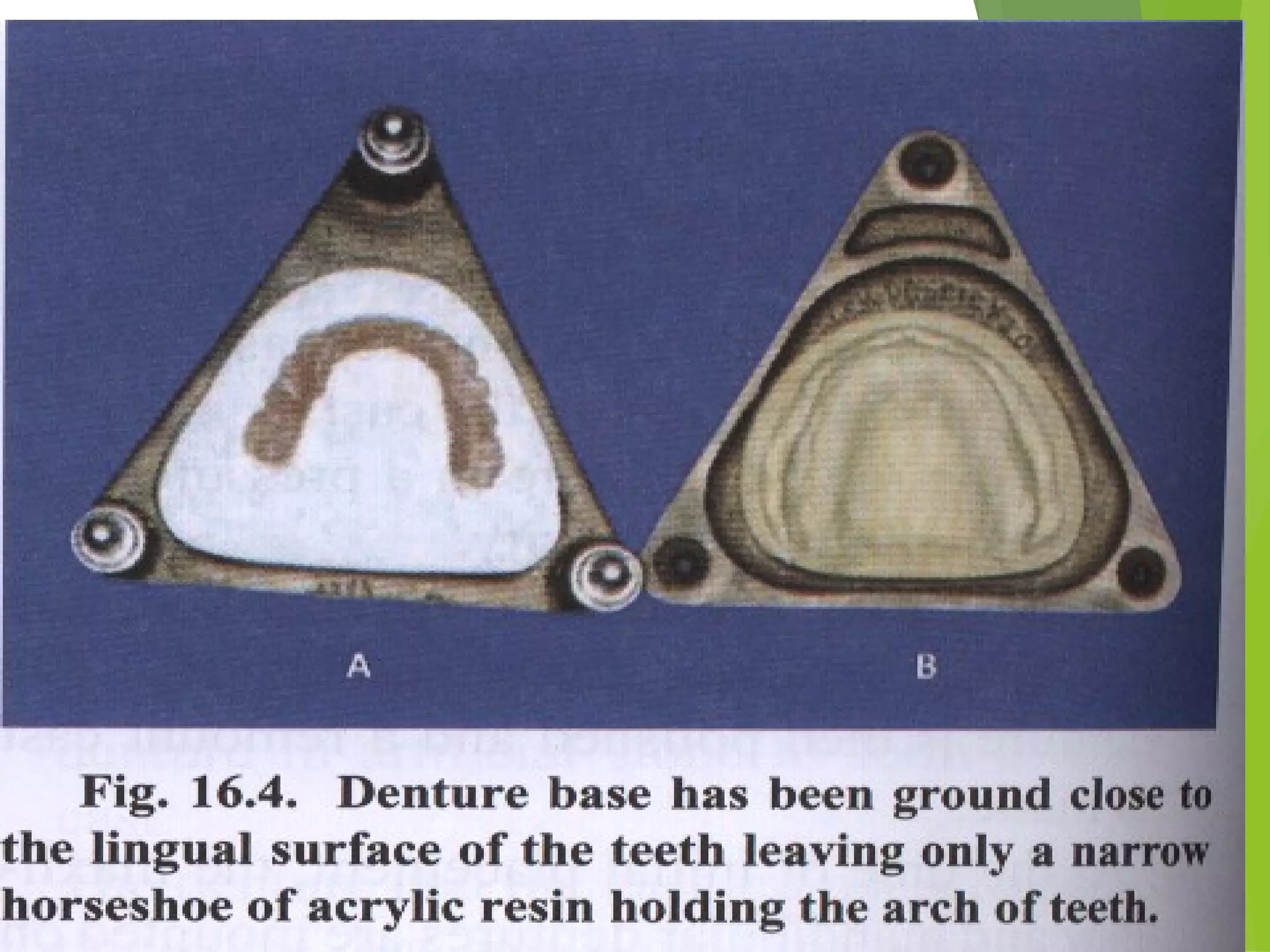 Relining and rebasing of complete dentures | PPT