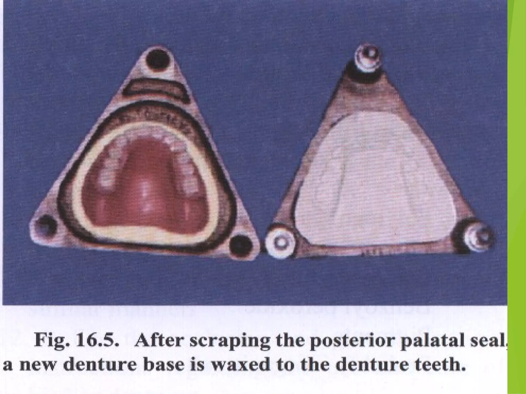 Relining and rebasing of complete dentures | PPT